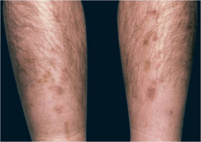 Dermatologic manifestations of diabetes mellitus – My Endo Consult