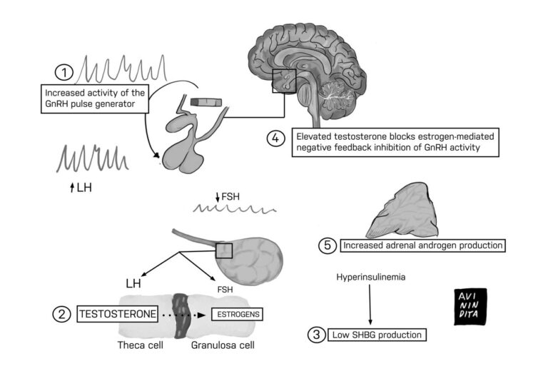 Pathophysiology of Polycystic Ovary Syndrome (PCOS) – My Endo Consult