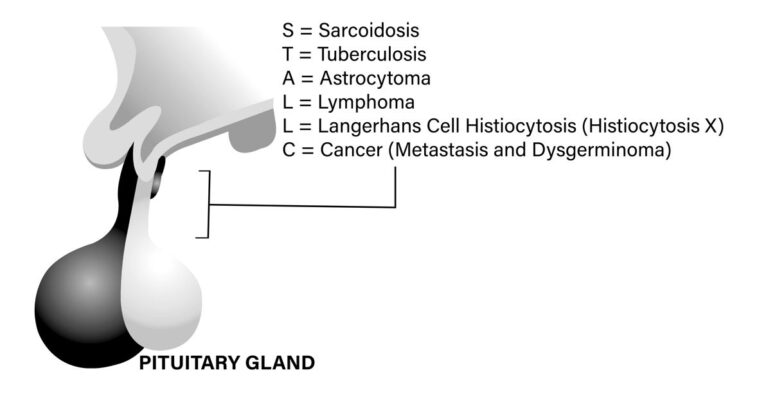 Pituitary stalk thickening – My Endo Consult
