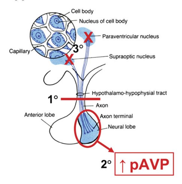 Triphasic Response of Diabetes Insipidus – My Endo Consult